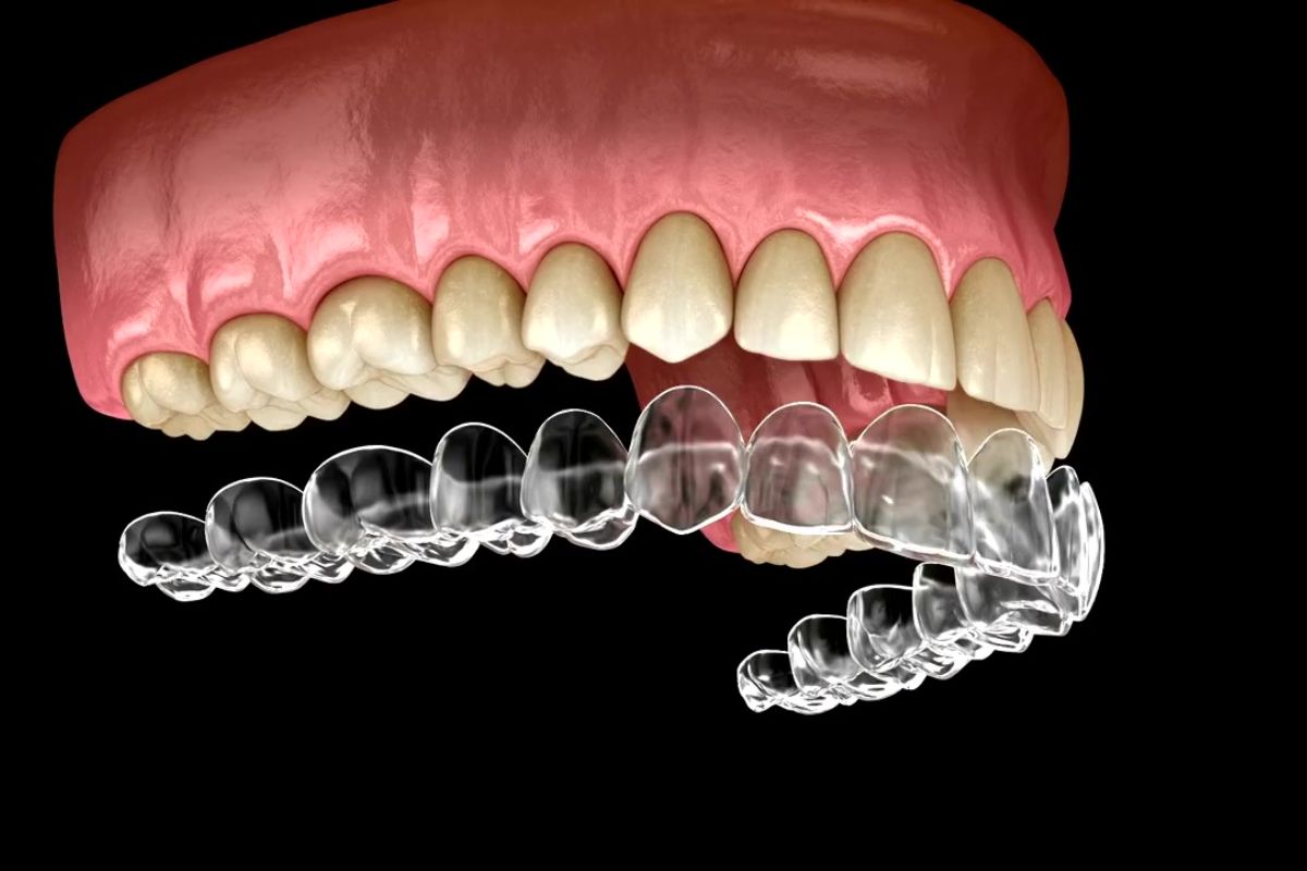 How to Repair Decalcification After Braces Effectively