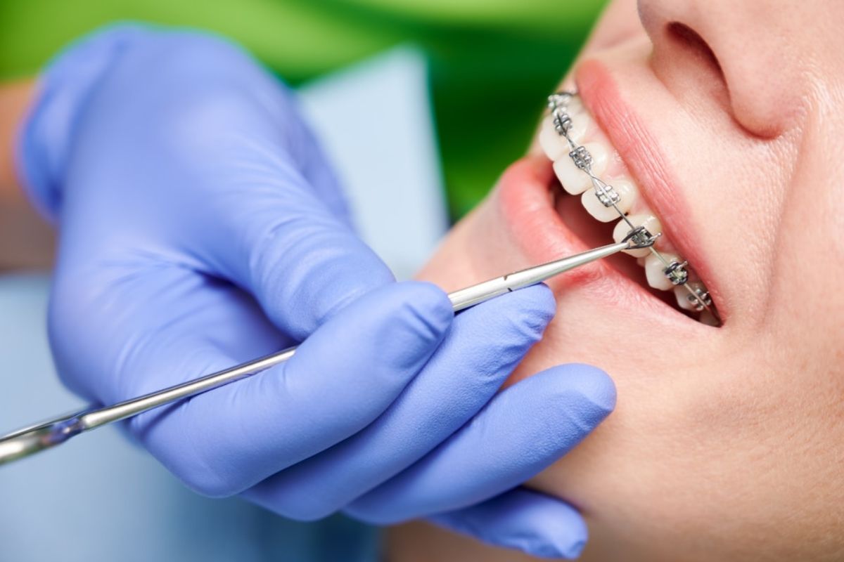 Sore Teeth From Braces: What’s Normal and What’s Not?